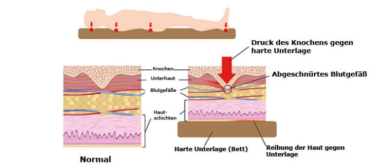 Dekubitus-Behandlung bei Querschnittlähmung - Der-Querschnitt.de
