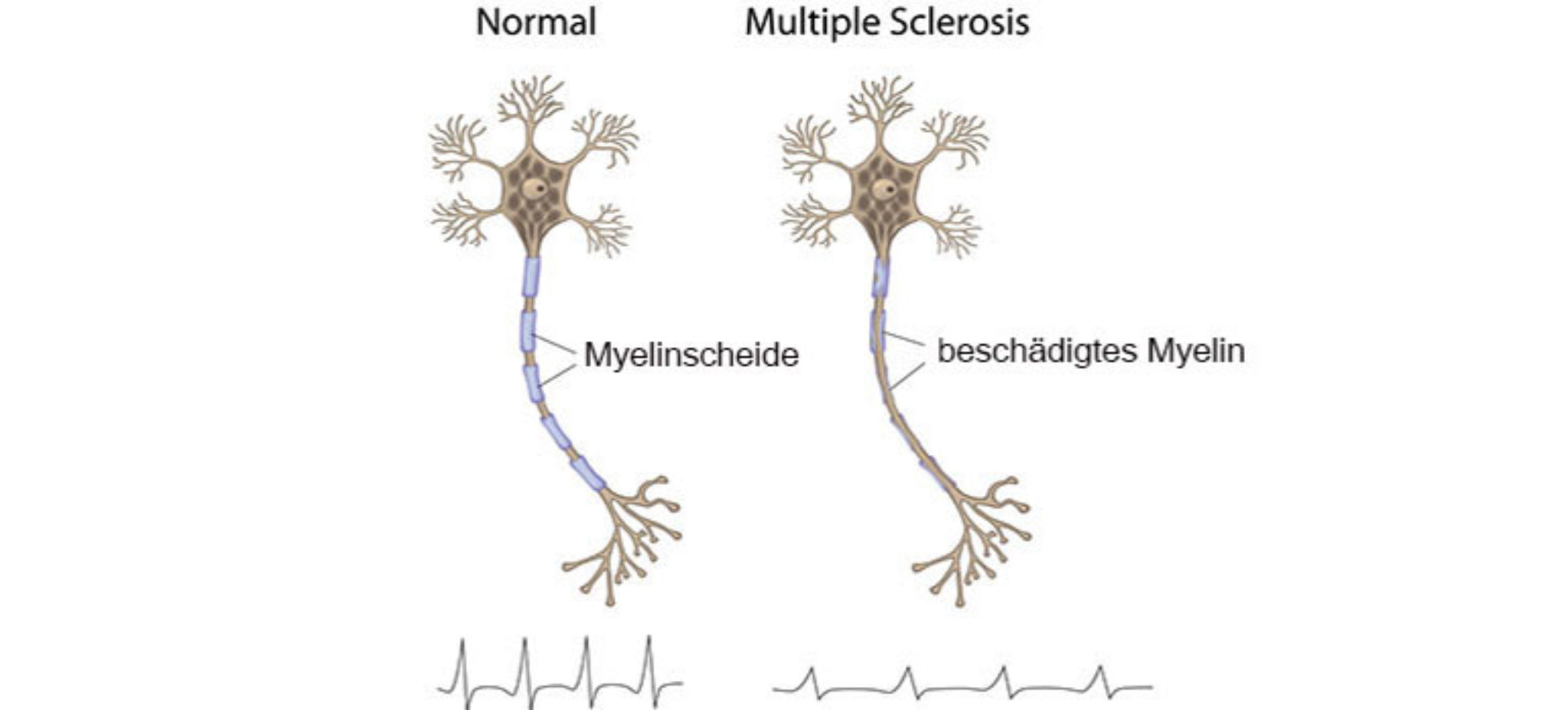Multiple Sklerose und Querschnittlähmung - Der-Querschnitt.de
