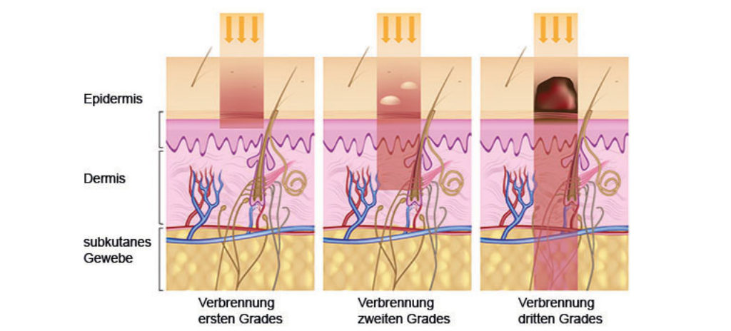 Mit Verbrennungen bei Querschnittlähmung richtig umgehen - Der ...